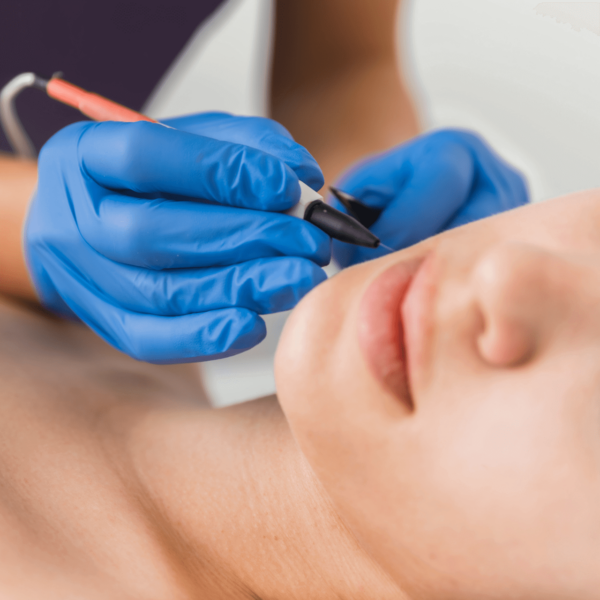 Hamilton Electrolysis Services | Radiance Laser Clinic